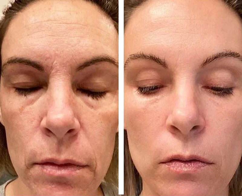 Skip the Line Instant Wrinkle Eraser – Beautykomi